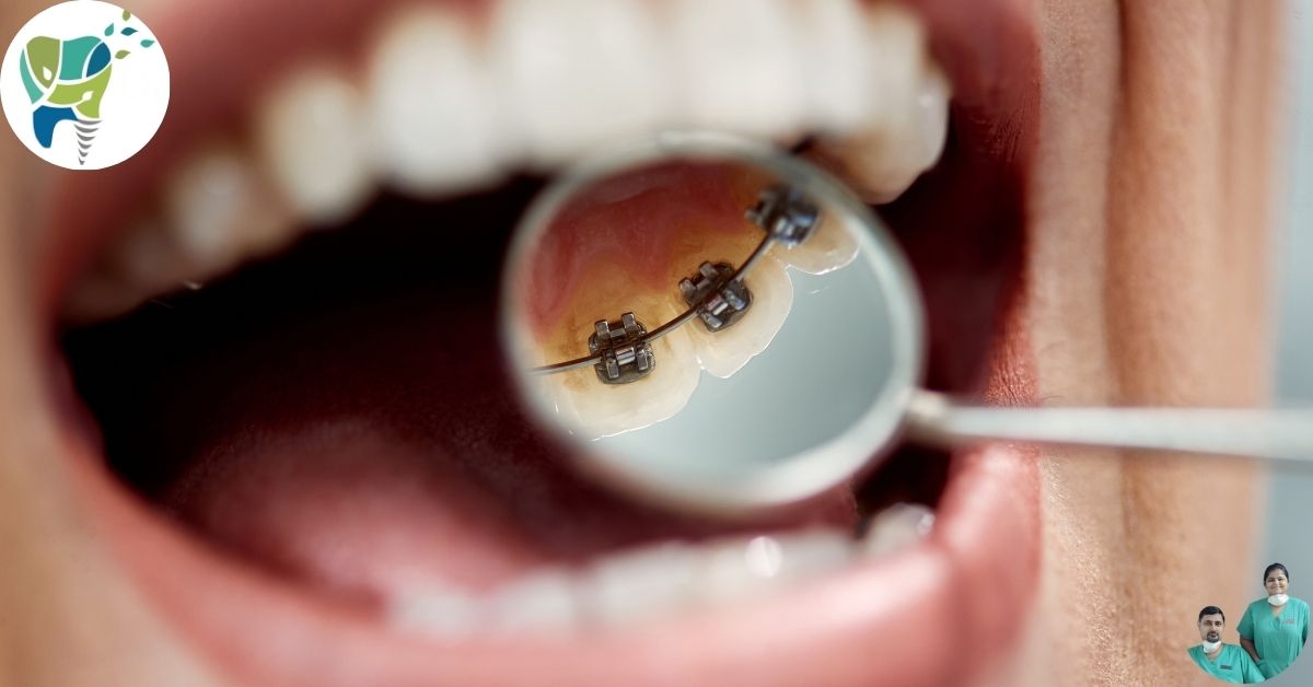 Comprehensive Guide to Braces | Orthodontic Solutions