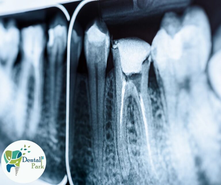 RTC vs RCT: Decoding Root Canal Treatment
