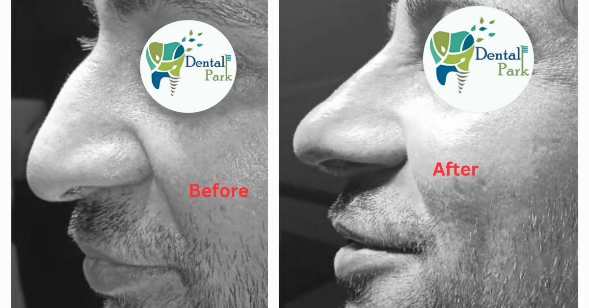 Rhinoplasty in Delhi NCR: Expert Care by Dr. Aakash Arora - Best ...