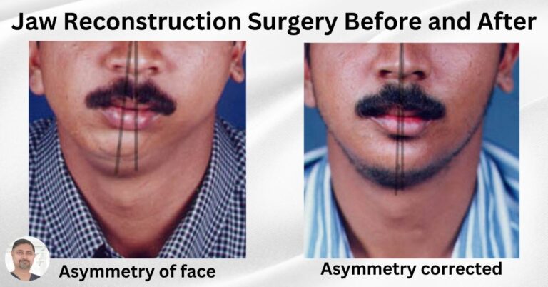 Reconstructive Jaw Surgery by Dr. Aakash Arora | Dental Park - Best ...