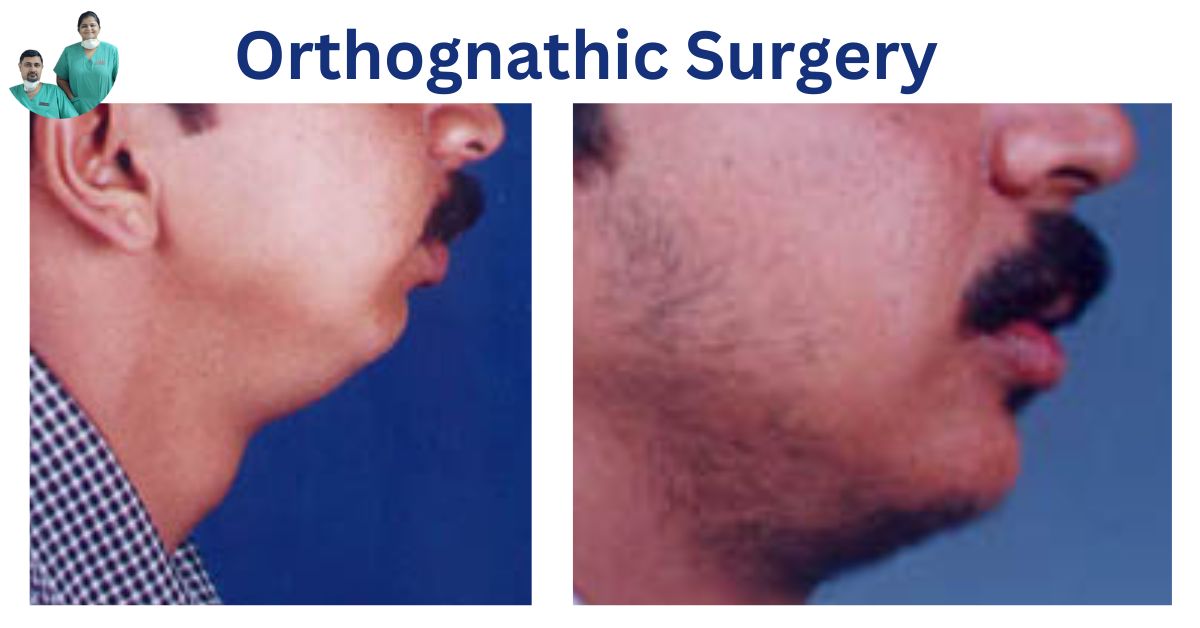 Orthognathic Surgery by Dr. Aakash Arora | Dental Park - Best Dentist ...