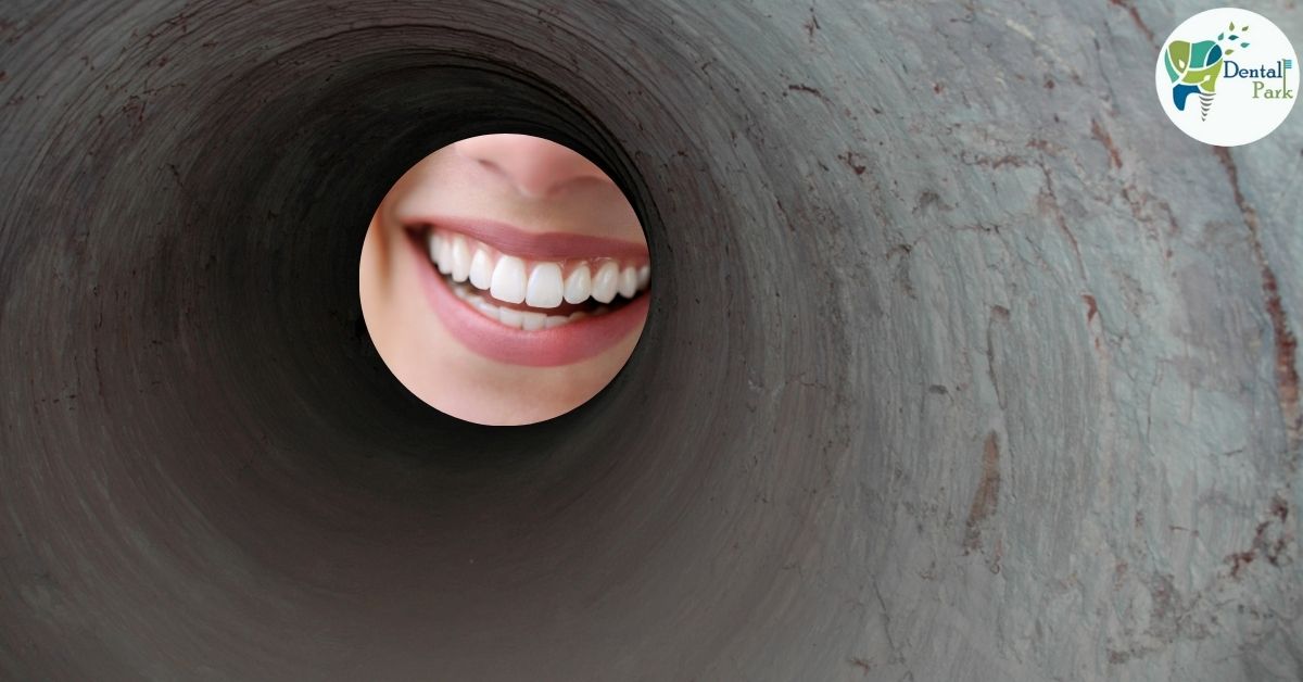 Tunnel Technique: Advanced Gum Recession Treatment - Best Dentist in ...