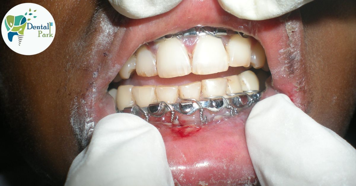 Jaw Fracture Treatment by Dr. Aakash Arora | Dental Park - Best Dentist ...