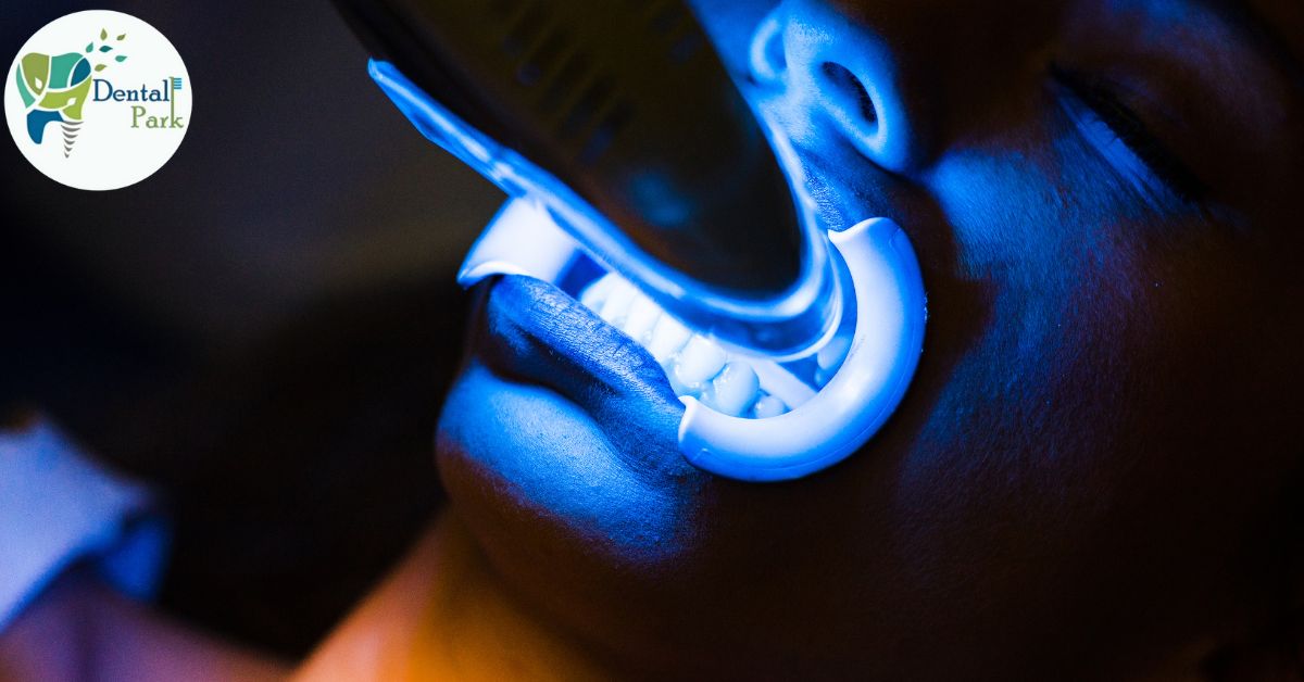 Laser Teeth Whitening: Transform Your Smile in One Hour