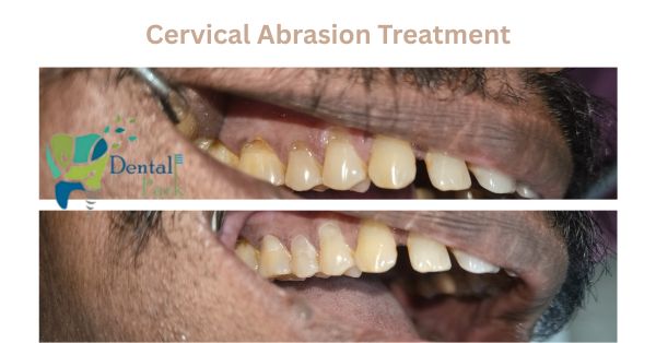 🦷 5 Expert Ways to Conquer Abrasion in Dentistry & Restore Your Smile