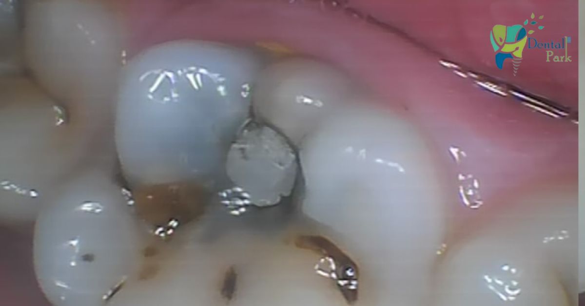 Silver Amalgam vs. Composite Fillings
